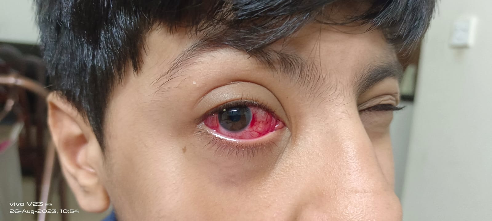 Etiology, Pathogenesis, and Management of Viral Conjunctivitis ...