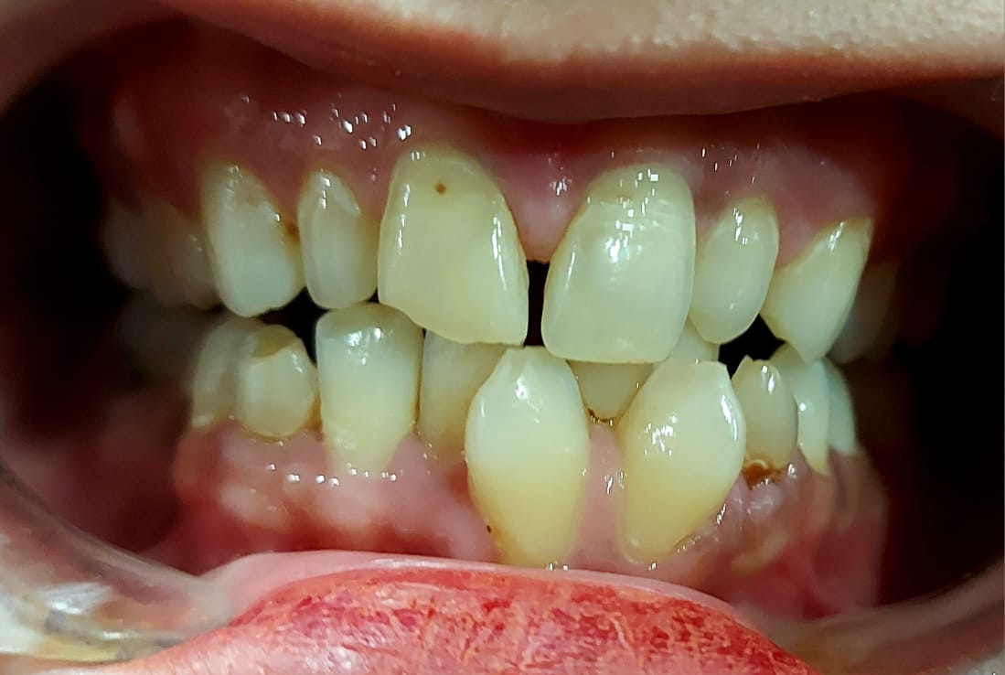 Understanding Ectopic Eruption of Permanent Canines