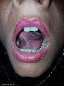 Understanding Ranula: A Comprehensive Guide for Dental Students